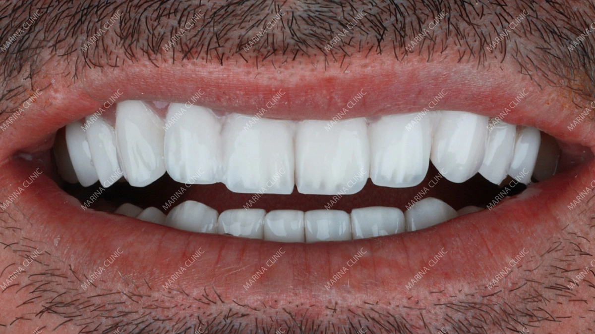 What Is a Hollywood Smile? Understanding Veneers, Crowns, Implants, Gum ...